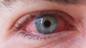 Επιπεφυκίτιδα: Τι είναι & Αντιμετώπιση | Δρ. Μπεζάτης